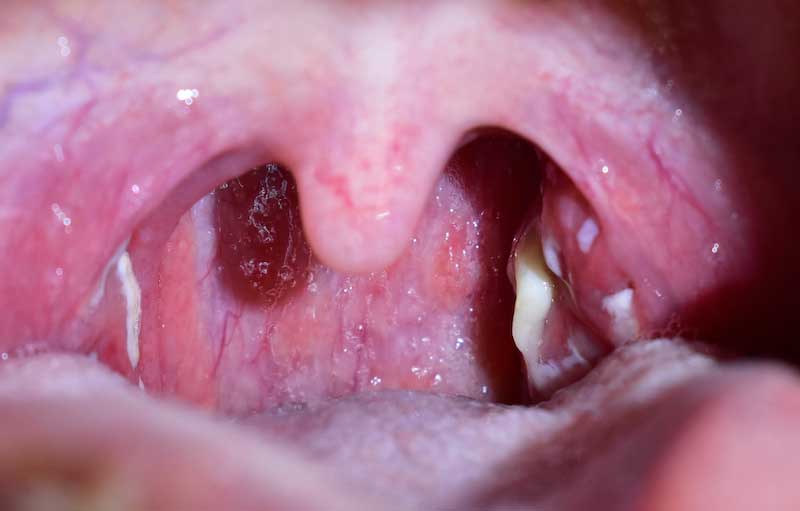 Gnojna Angina kod Dece [Simptomi, Lečenje i Prevencija]